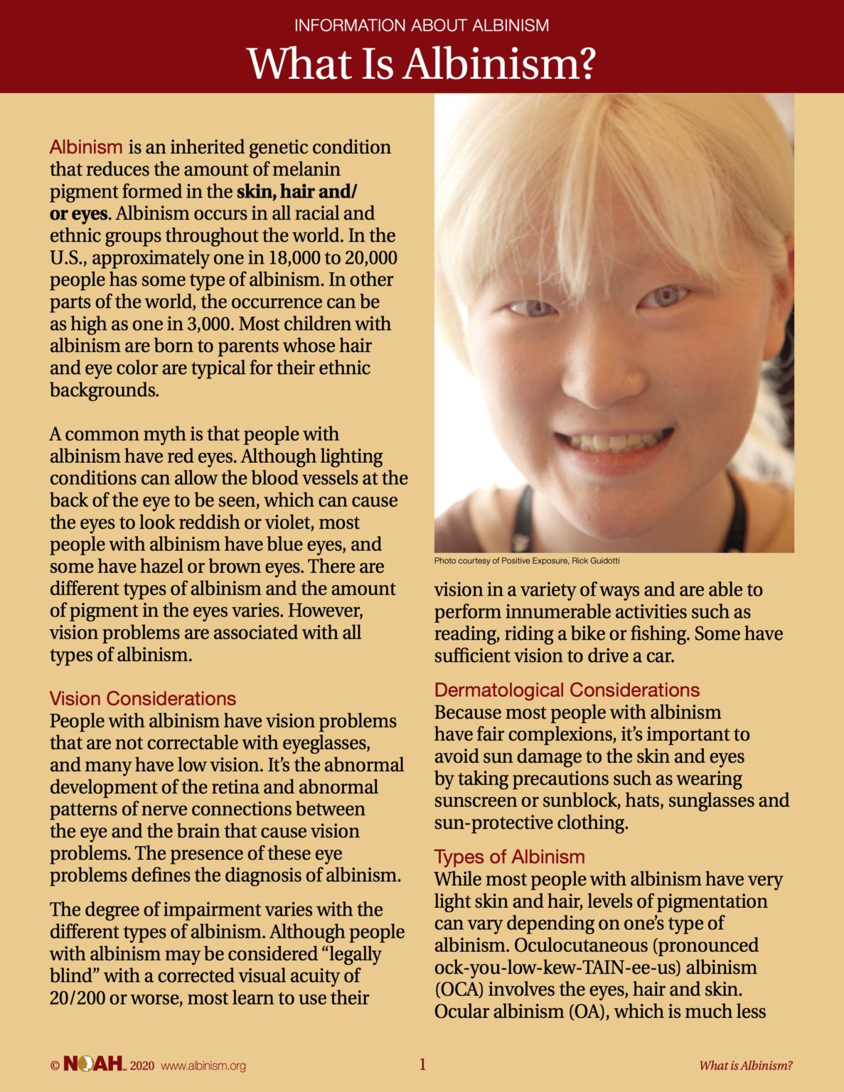 About Albinism and Hypopigmentation | National Organization for ...